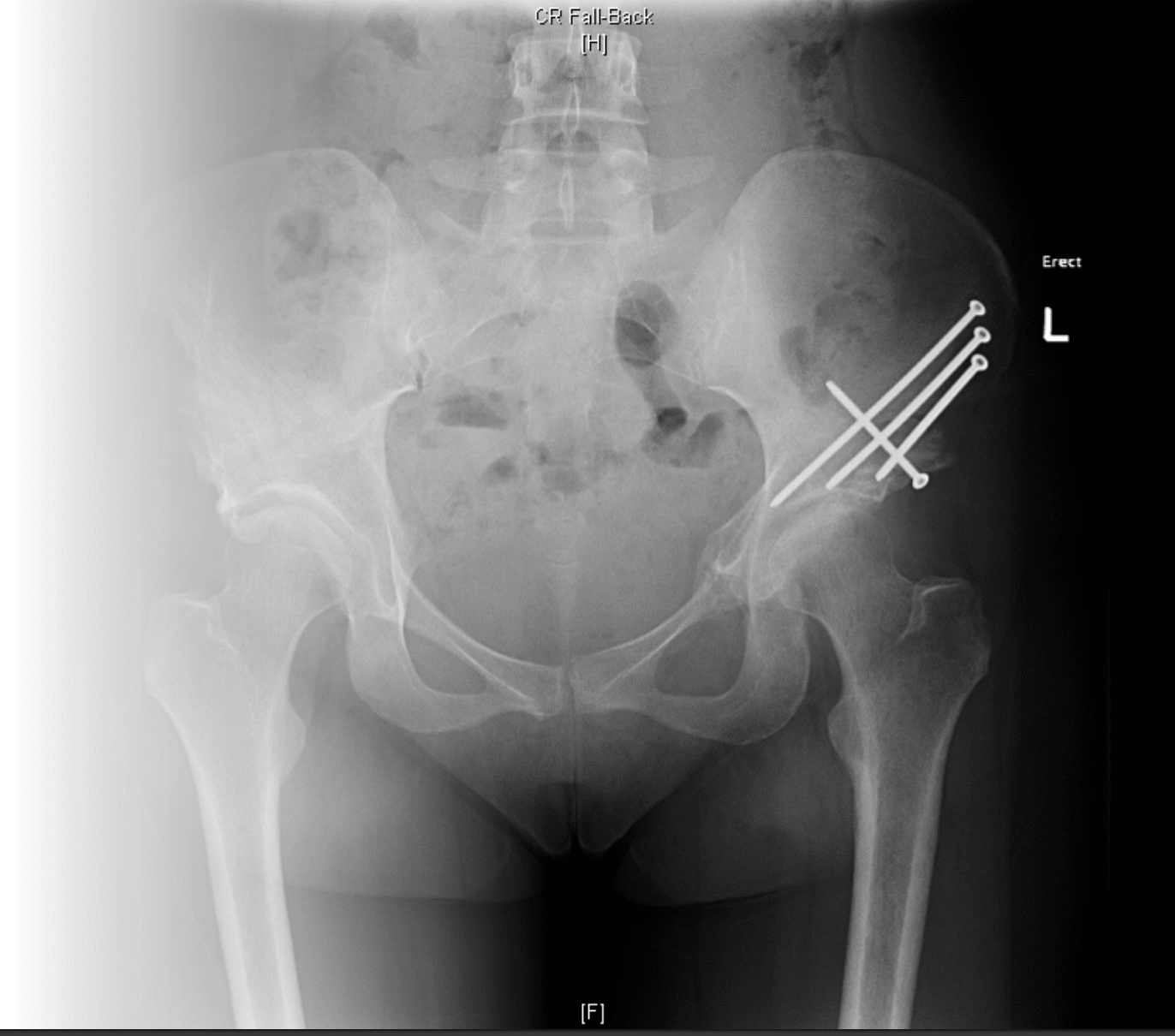 A Major Milestone in Hip Care: HMH Riverview Hospital’s First PAO ...
